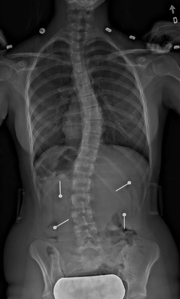 What is Scoliosis? – SpineCor Scoliosis Bracing Toronto
